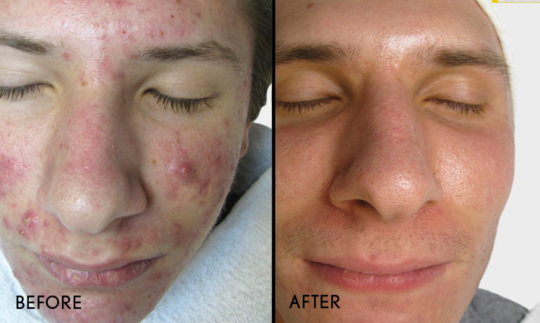 Testimonials – Face Reality Acne Clinic